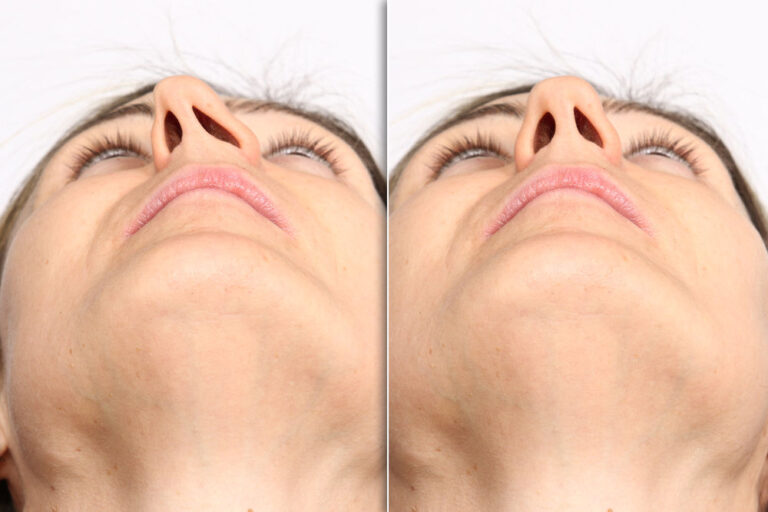 Septoplasty in Houston | Deviated Septum Surgery Specialist